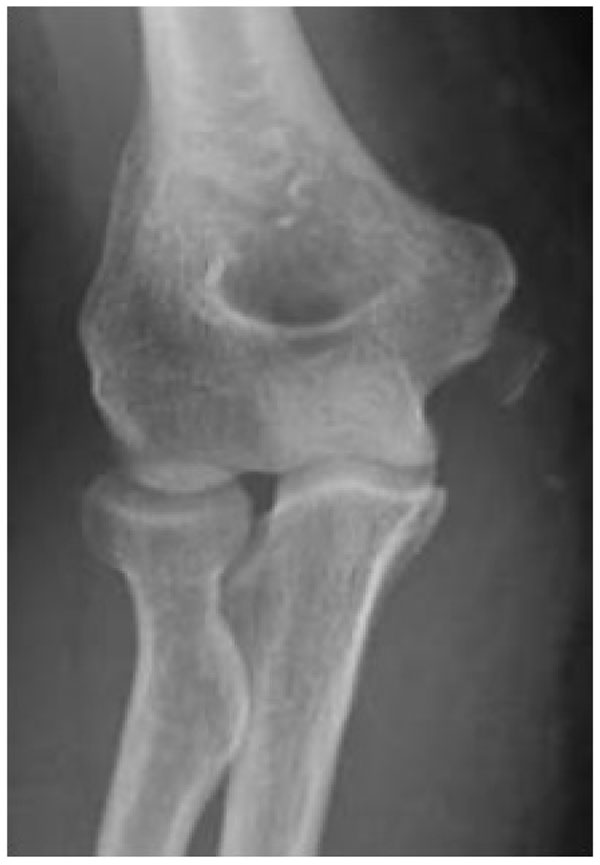 2019 Icd 10 Code For Joint Effusion Right Elbow 2019 Icd 10 Code For Joint Effusion Right Elbow