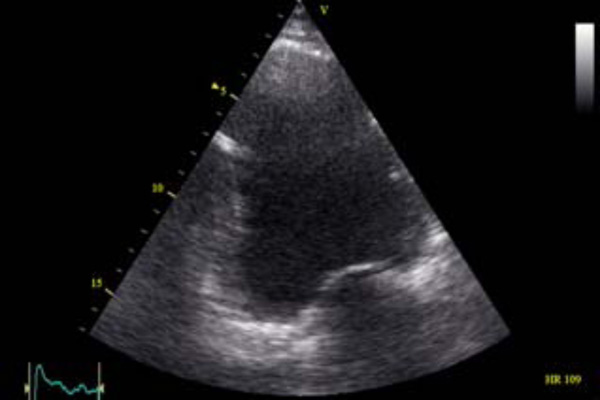 Calcified Left Ventricular Aneurysm: “An Egg in the Heart”