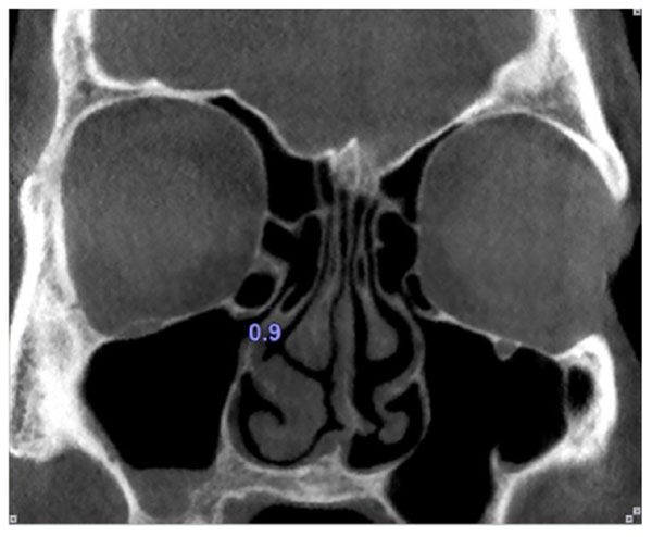 Cone Beam Ct Sinus - The Best Picture Of Beam