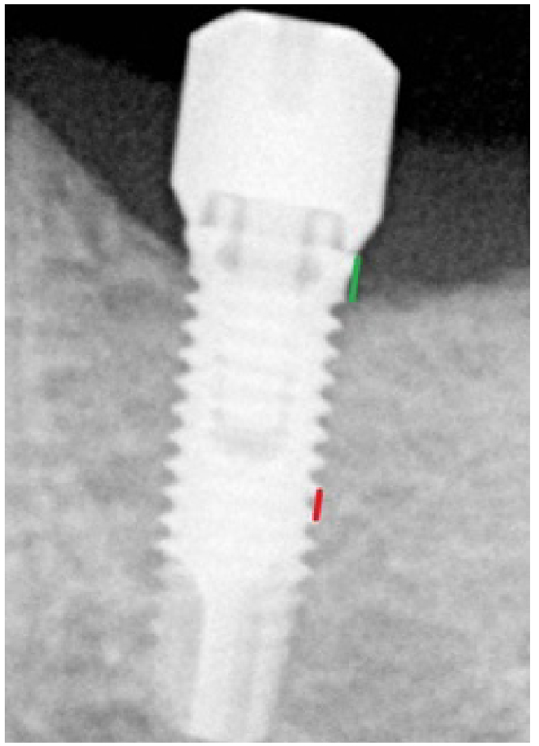 Peri-Implant Bone Loss at Implants Placed in Preserved Alveolar Bone ...