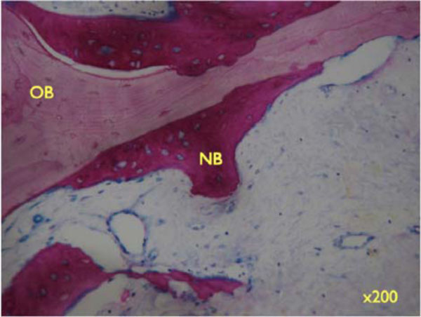 Histomorphometric Evaluation of Anorganic Bovine Bone Coverage to ...