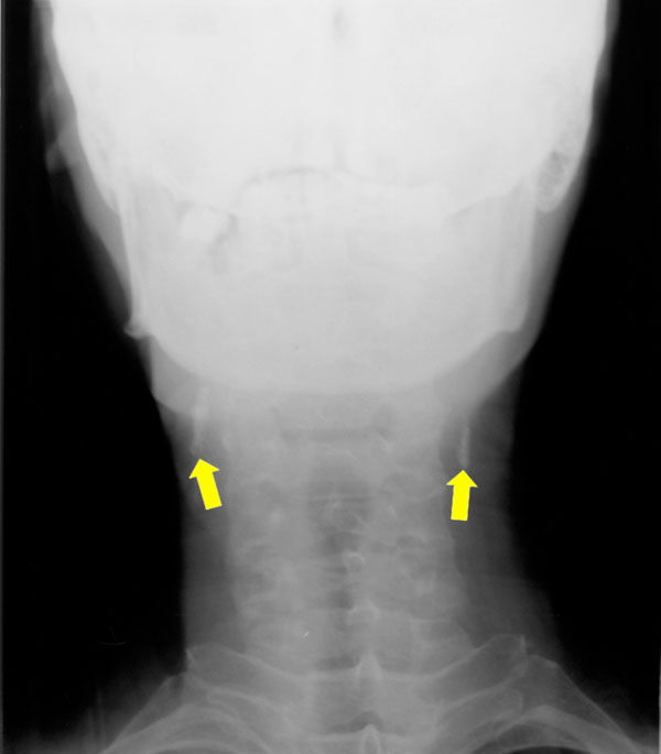 Carotid Artery Calcification