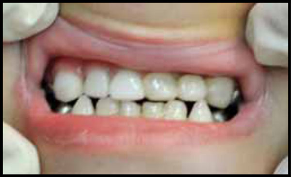 The Use of Glass-fibers Ribbon and Composite for Prosthetic Restoration ...