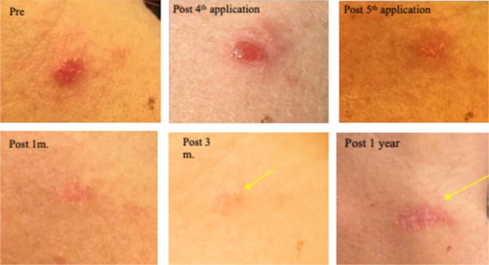 Basal Cell Carcinoma Destruction by a Concentrate of Proteolytic ...
