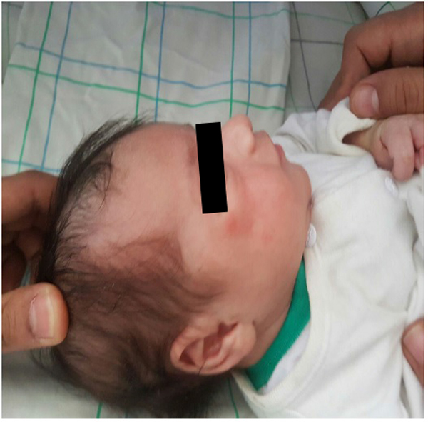 Neonatal Cellulitis ~ Fulltext