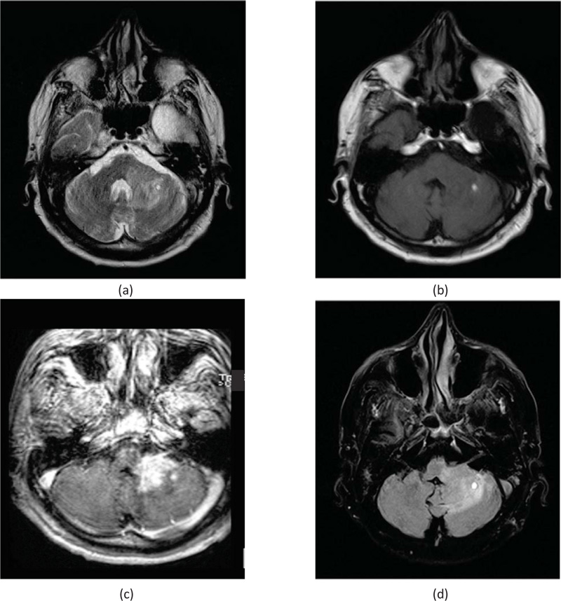 Traditional and Advanced Neuroimaging Contributions to the Diagnosis ...