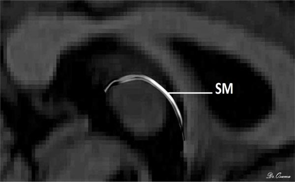 Diffusion Tensor Imaging: A Promising New Technique for Accurate ...