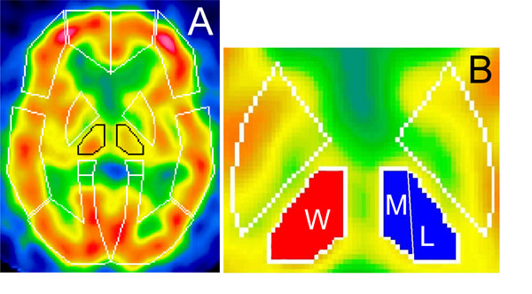 Alterations of Contralateral Thalamic Perfusion in Neuropathic Pain