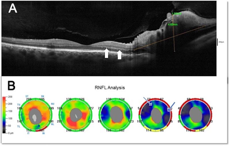 A Case of Papillophlebitis Caused by the Contraceptive Implant in a ...