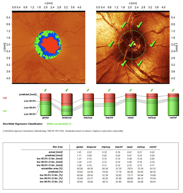 HRT for the Diagnosis and Detection of Glaucoma Progression