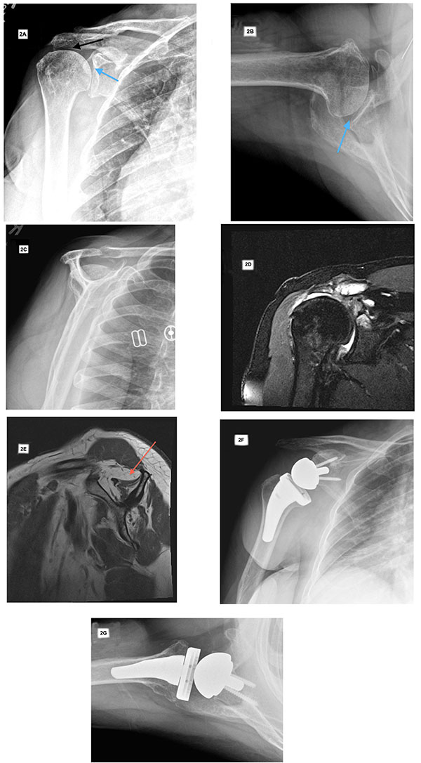 Irreparable Rotator Cuff Tears Without Arthritis Treated With Reverse ...
