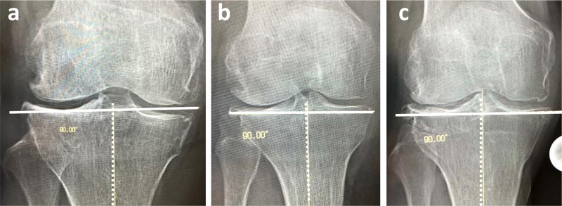 Proposal of a New Reference Point to Determine the Tibial Resection ...