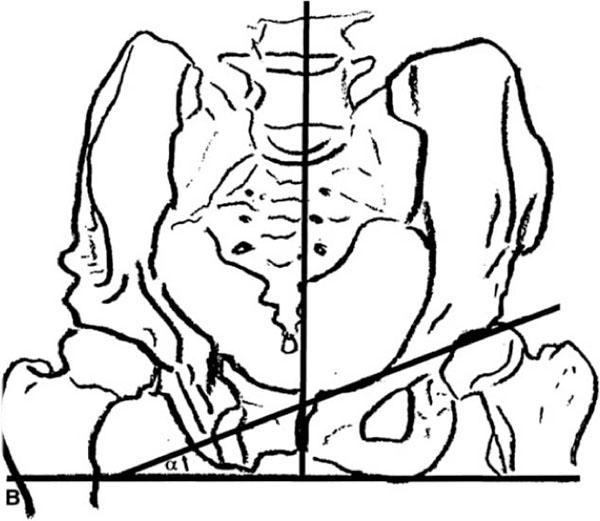 Triangle Tilt and Steel Osteotomy: Similar Approaches to Common Problems