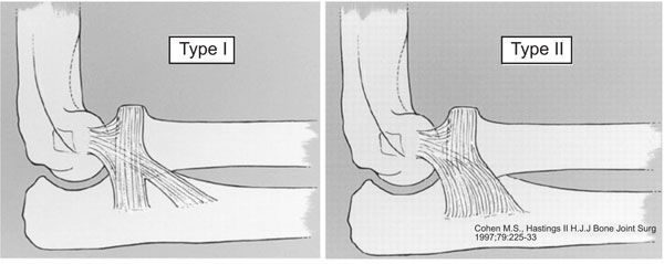 Stability of the Elbow Joint: Relevant Anatomy and Clinical ...