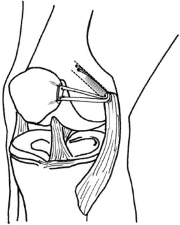 Medial Patellofemoral Ligament Reconstruction: A Longitudinal Study ...