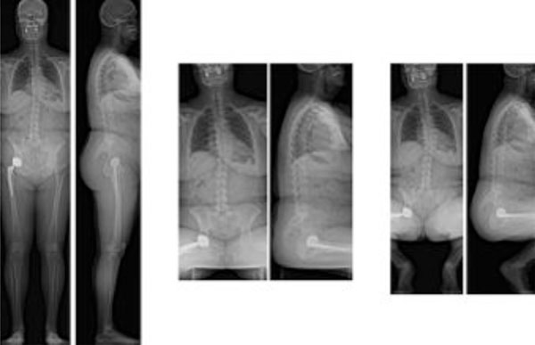 Total Hip Prostheses in Standing, Sitting and Squatting Positions: An ...