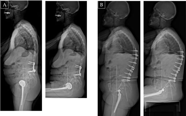 Total Hip Prostheses in Standing, Sitting and Squatting Positions: An ...