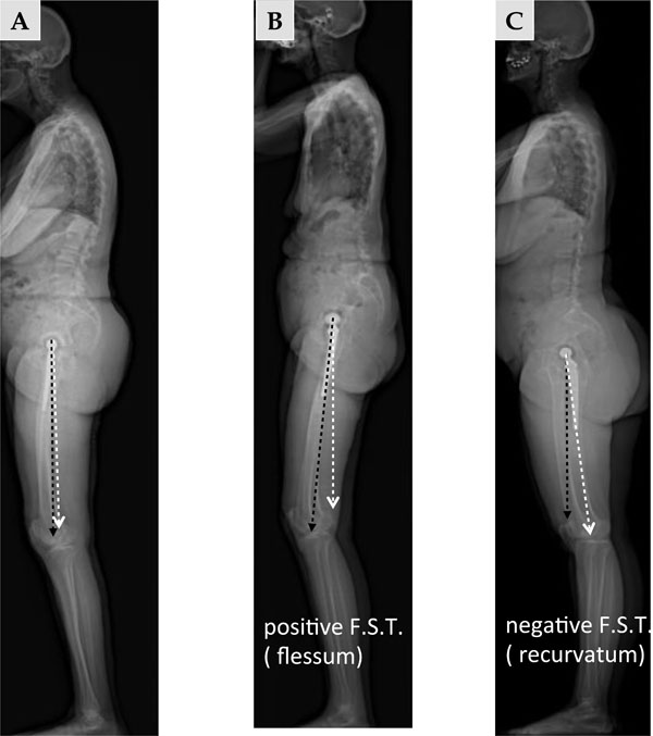 Total Hip Prostheses in Standing, Sitting and Squatting Positions: An ...