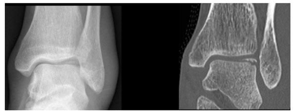 Acute Osteochondral Fractures in the Lower Extremities - Approach to ...