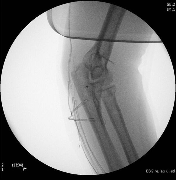 Traumatic Rupture of the Distal Triceps Tendon (A Series of 7 Cases)
