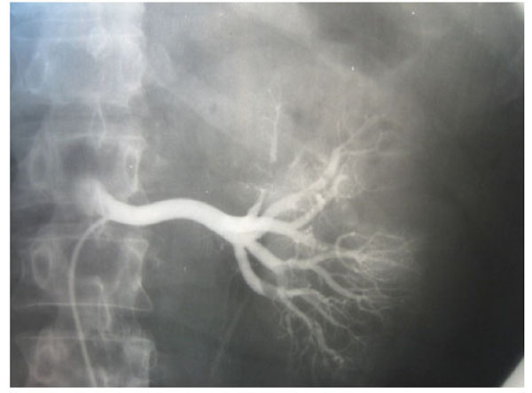Renal Artery Embolism: Prospective Study of 41 Patients Based on a ...
